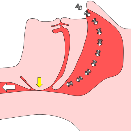 Hypoventilation Definition, Causes & Treatment - Lesson | Study.com