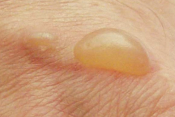 Blood Blister | Causes, Symptoms & Treatment - Lesson | Study.com