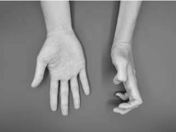 Myalgia | Definition, Symptoms & Treatments - Lesson | Study.com