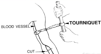 Tourniquet Definition, Types & Uses - Lesson | Study.com