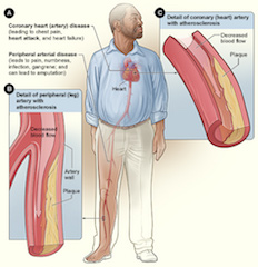 Acute Peripheral Vascular Insufficiency: Definition & Types | Study.com