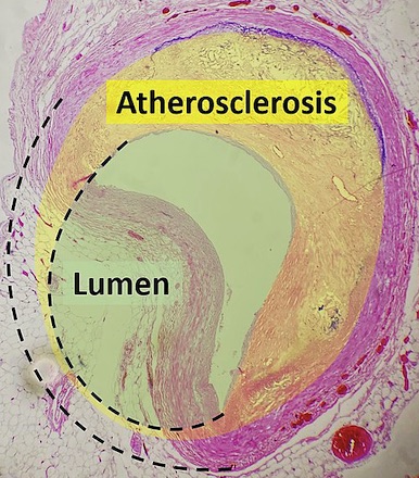 Arterial vs. Venous Ulcers | Characteristics & Differences - Lesson ...