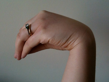 What is Hypocalcemia? - Causes, Symptoms & Treatment | Study.com