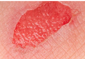 Tunneling vs. Undermining Wound | Definition & Overview - Lesson ...