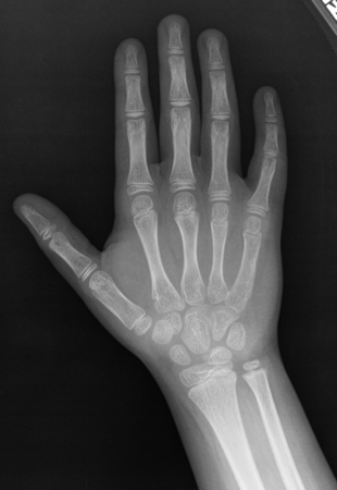 Paresthesia | Definition, Symptoms & Treatment | Study.com