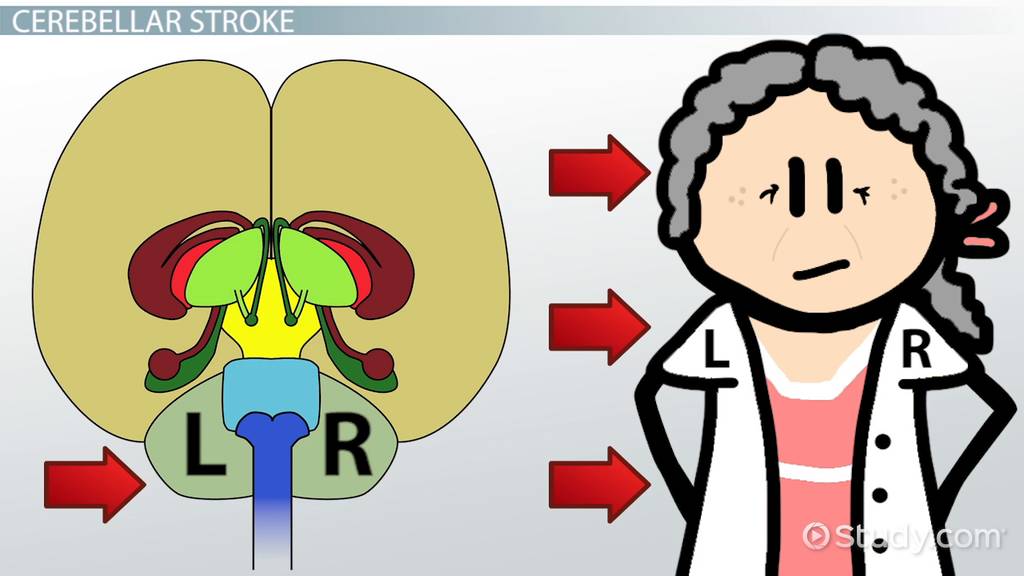 Cerebellar Stroke: Prognosis & Recovery - Video | Study.com
