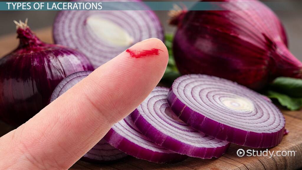 Laceration | Definition, Types & Treatment - Lesson | Study.com