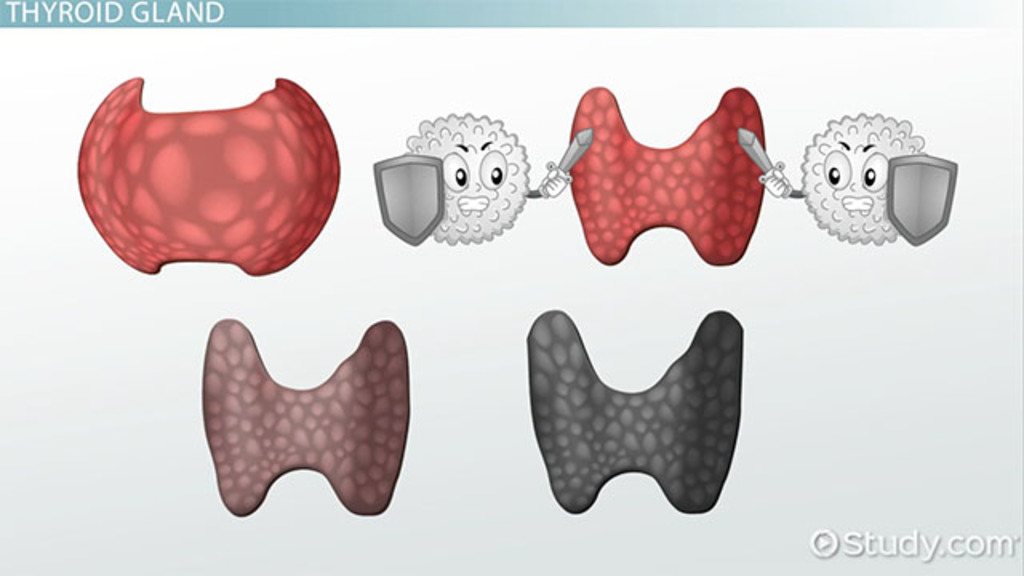 Terminology Related to Underactive Thyroid Disorders - Lesson | Study.com