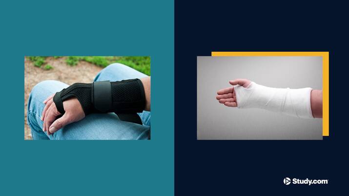 Splint vs. Cast | Overview, Differences & Uses - Video | Study.com