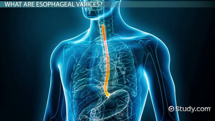 Esophageal Varices | Symptoms, Causes & Treatment - Lesson | Study.com