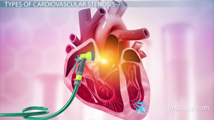 What Is Stenosis? - Definition, Types & Symptoms - Lesson | Study.com