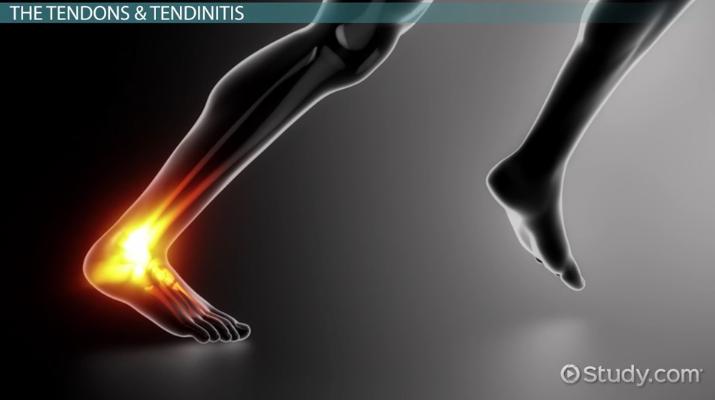 Fibers, Fascia & Tendon Disorders: Terminology - Video | Study.com