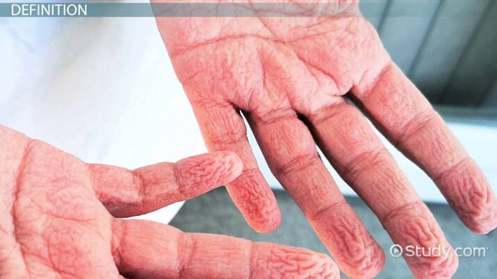 Maceration of Skin | Definition, Causes & Treatment - Video | Study.com