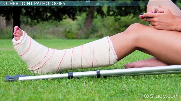 Joint Pathology - Lesson | Study.com