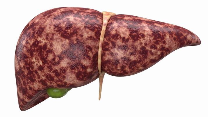 Liver Necrosis | Overview & Types - Video | Study.com