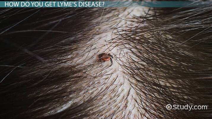 Lyme Disease Lesson for Kids - Lesson | Study.com