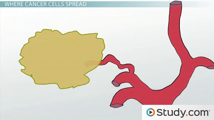 Metastasis in Cancer | Overview, Symptoms & Treatment - Lesson | Study.com