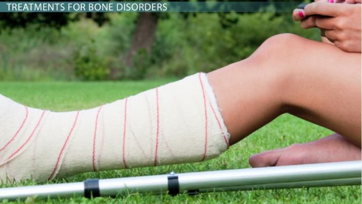 Medical Vocabulary for Bone Fracture Treatments - Lesson | Study.com