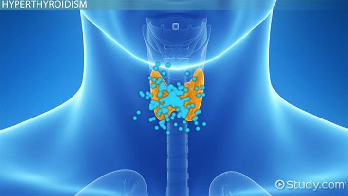 Terminology Related to Overactive Thyroid Disorders - Lesson | Study.com