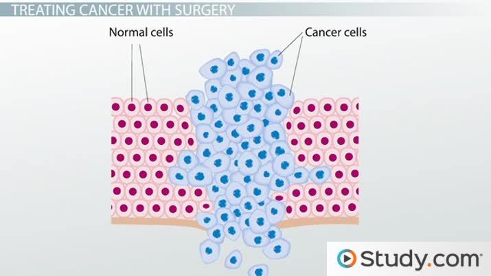 Cancer Treatment Overview & Options - Lesson | Study.com