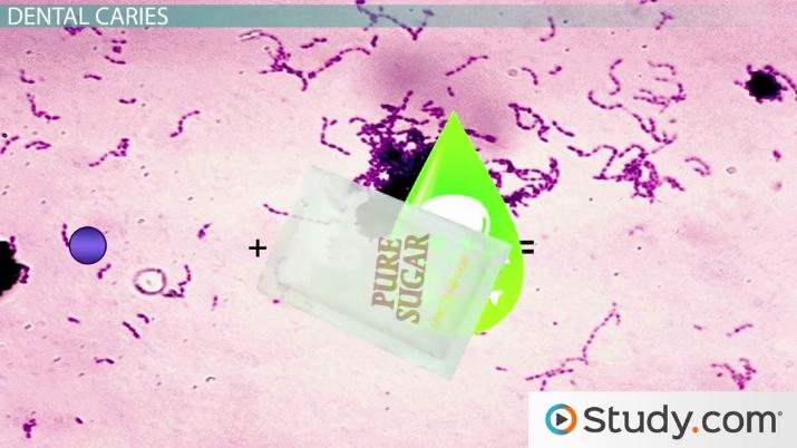 Cavities and Tooth Decay: Bacterial Causes of Common Dental Issues ...