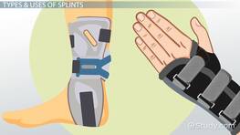 Splint Fabrication: Types & Functions | Study.com